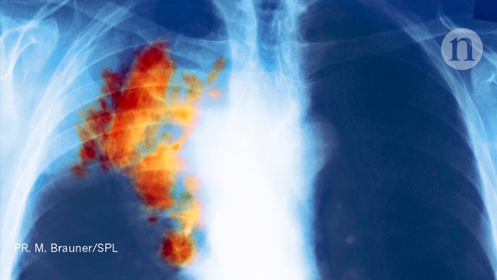 An aggressive cancer’s road to conquest