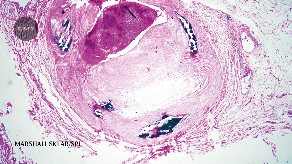 Inflammation in heart disease: do researchers know enough?