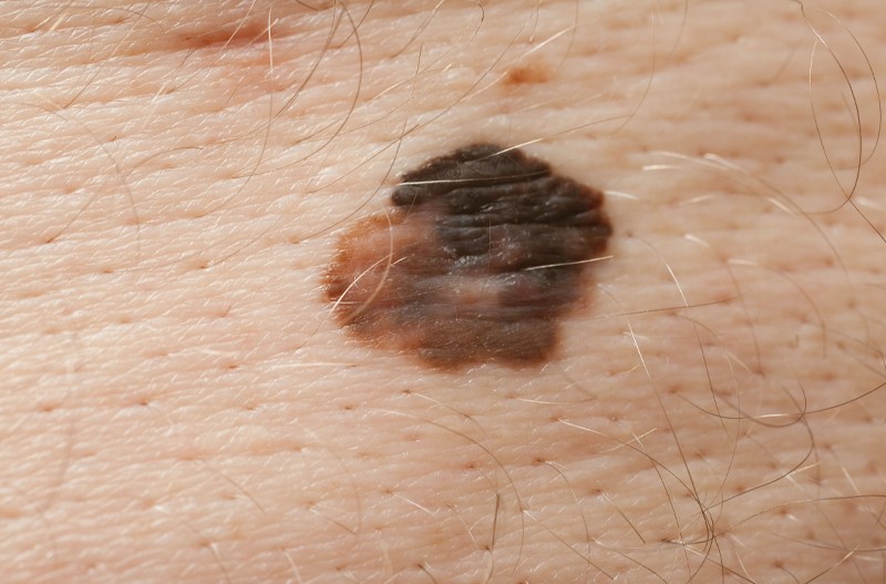 Earlier appears better for immunotherapy in melanoma