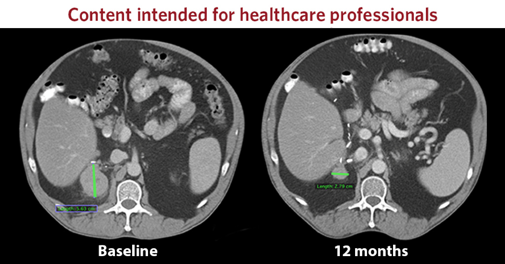 First FDA-approved treatment for an ultra-rare disease
