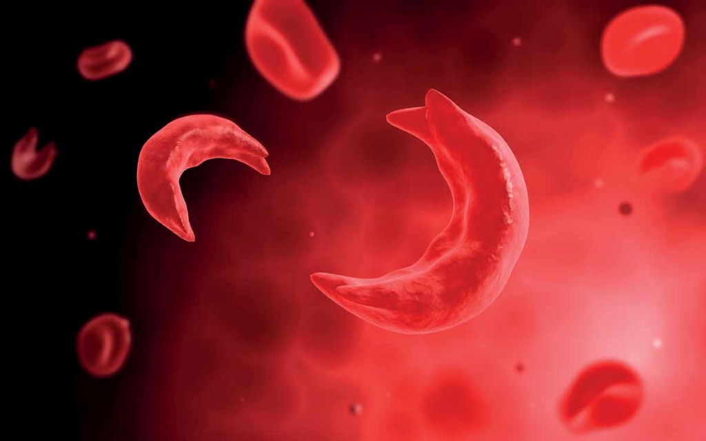 A red blood cell disease meets a company with a plasma protein heritage