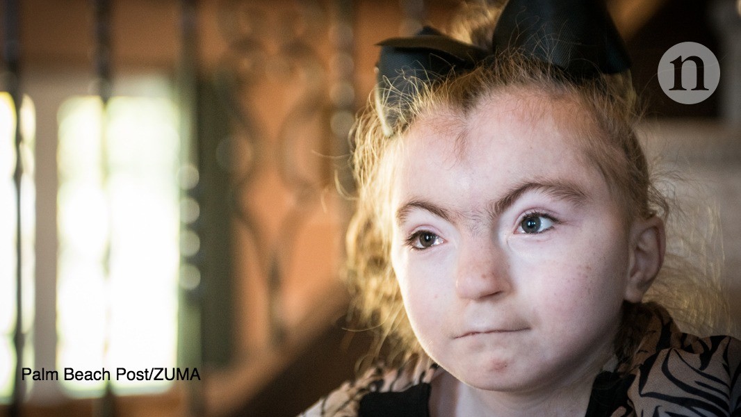 AI face-scanning app spots signs of rare genetic disorders