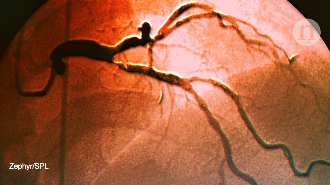 Where heart disease is making a comeback