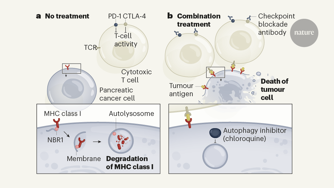 Pancreatic cancer hidden in plain sight