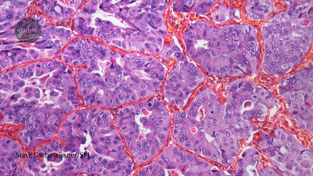 ‘Barcodes’ reveal a cancer’s life story