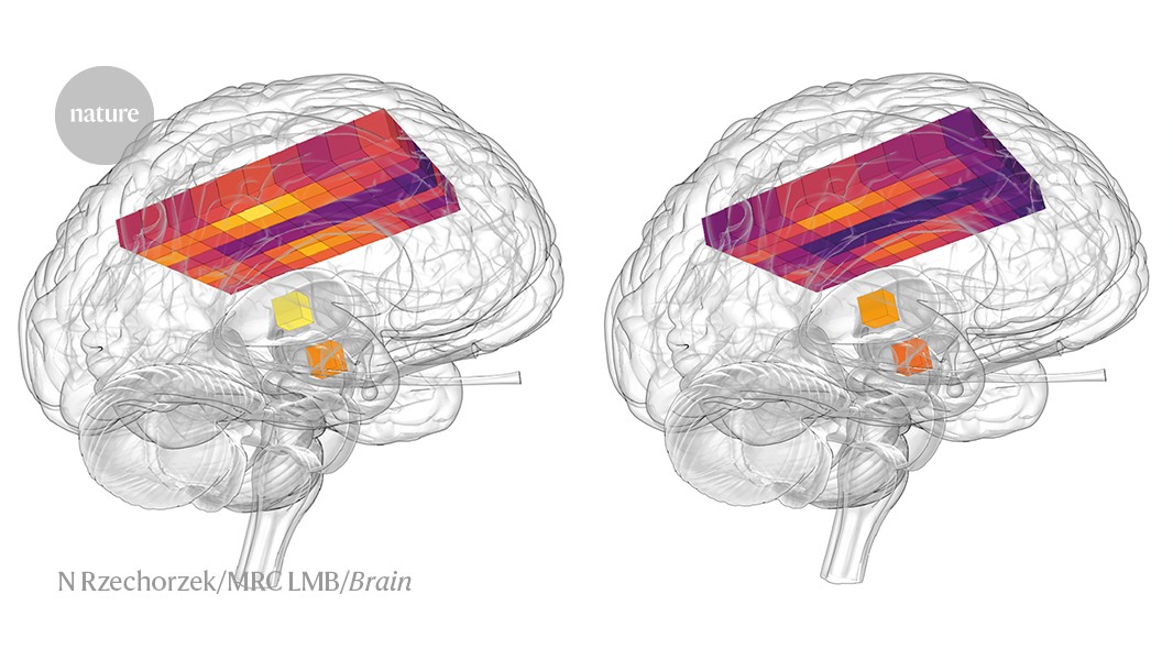 Human brains run hot — sometimes more than 40 °C