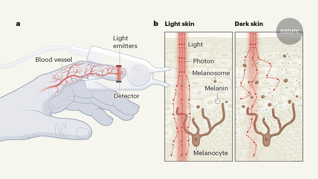Skin colour affects the accuracy of medical oxygen sensors