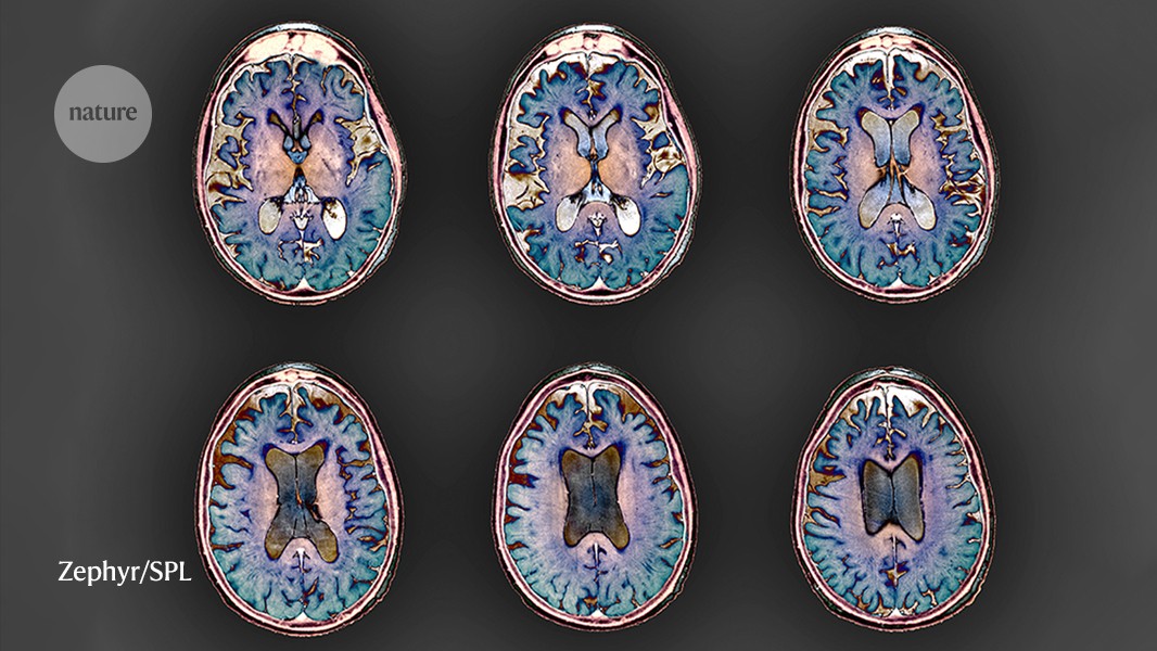 Alzheimer’s drug donanemab: what promising trial means for treatments