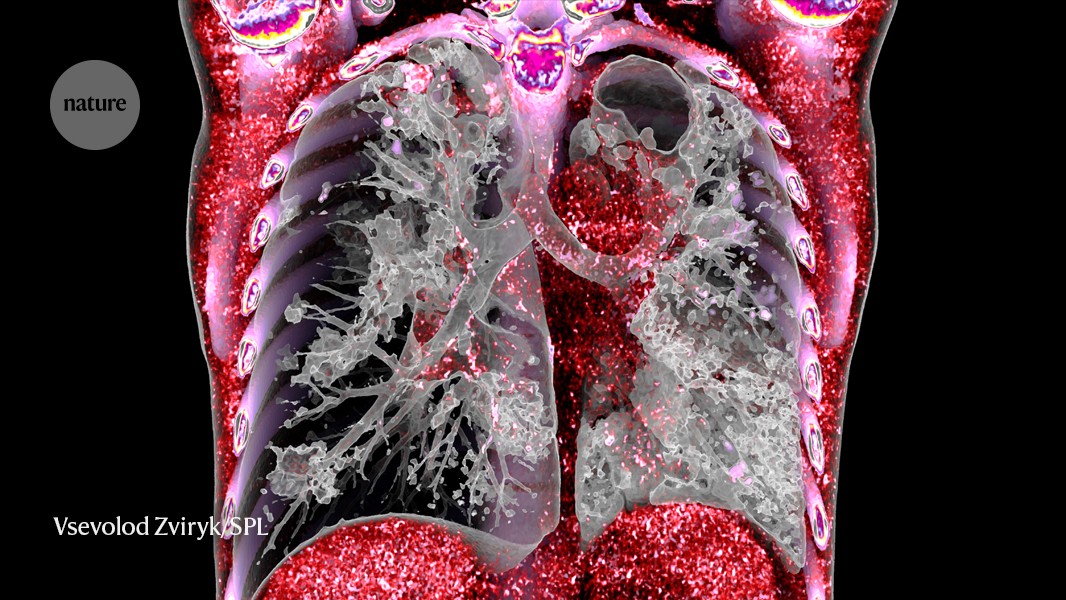 Promising tuberculosis vaccine gets US$550-million shot in the arm