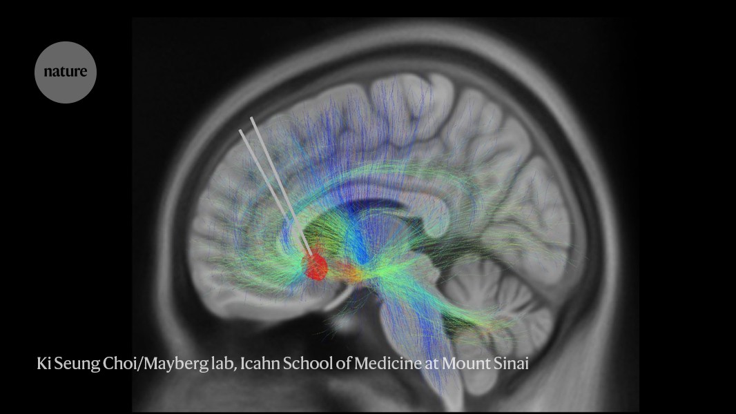 Is depression lifting? AI that interprets brain waves has answers