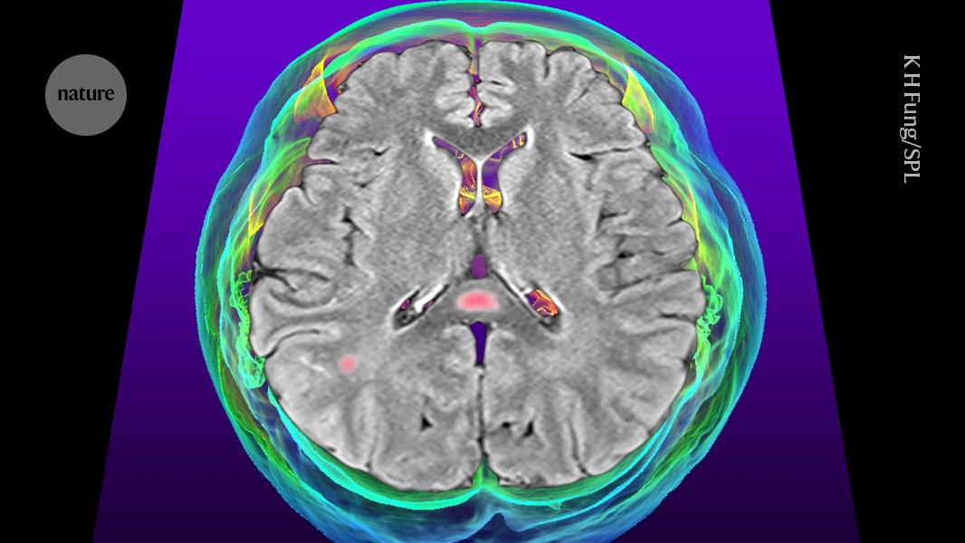 COVID’s toll on the brain: new clues emerge