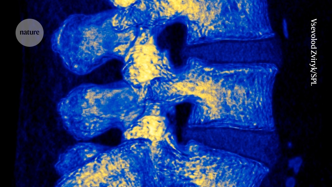 Drugs that target ‘zombie’ cells soothe an aching back