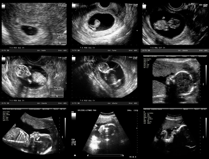 Simplifying obstetric sonography with AI