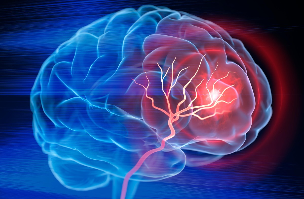 Electrical stimulation signals new hope for stroke patients
