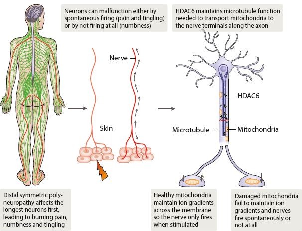 Regenacy is poised to deliver the first treatment for peripheral neuropathy