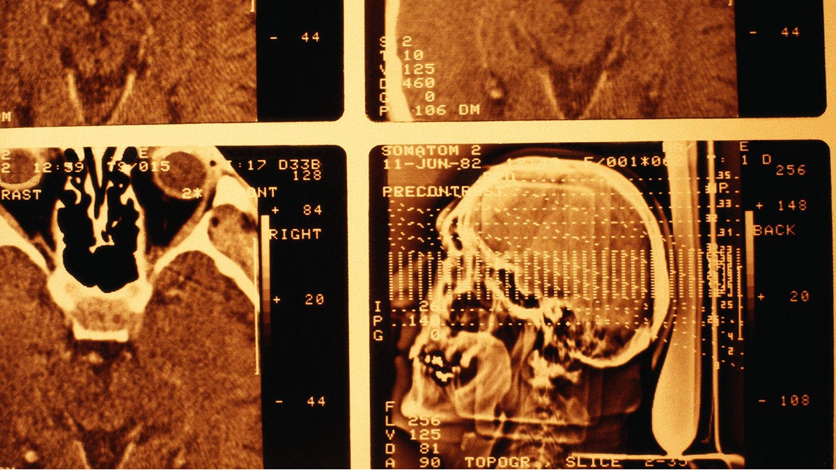 Evolution of the landscape for central nervous system disorder therapies