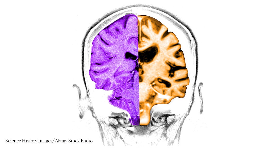 Rare brain inflammation may hold clues for treating Alzheimer’s