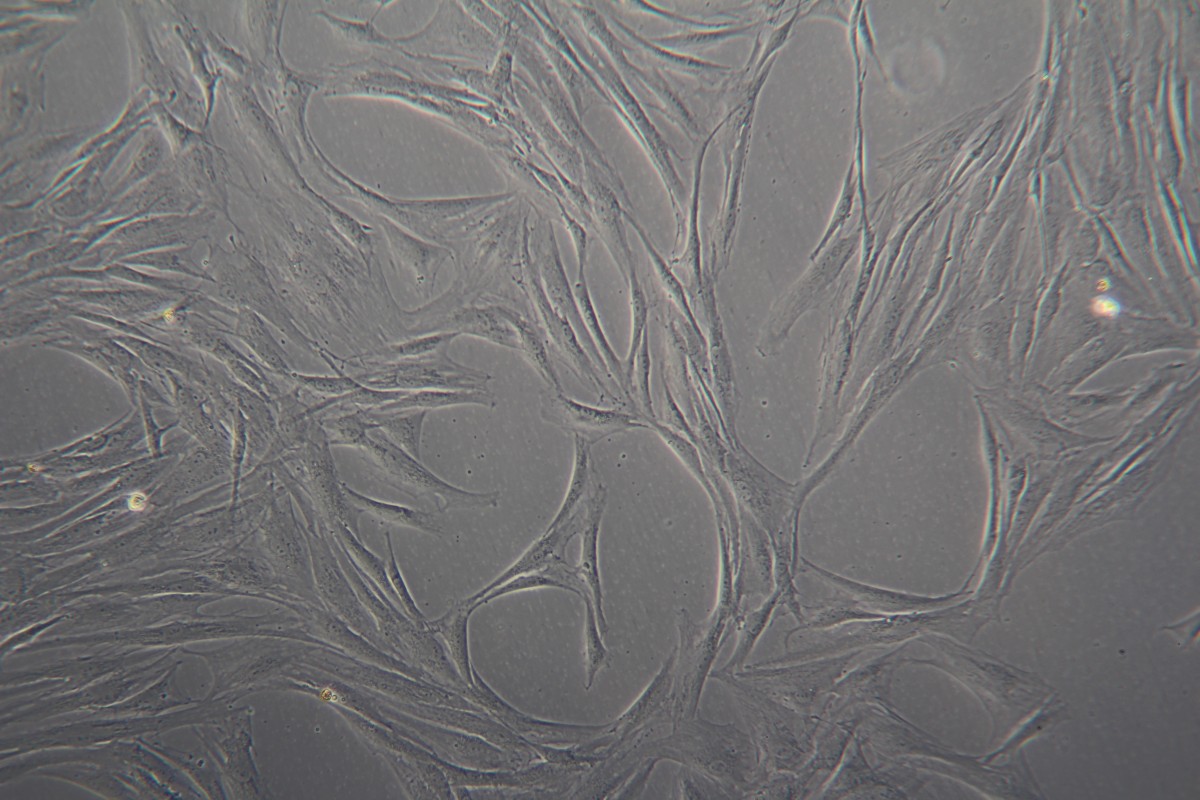 Post-traumatic stress damages skin cells involved in healing