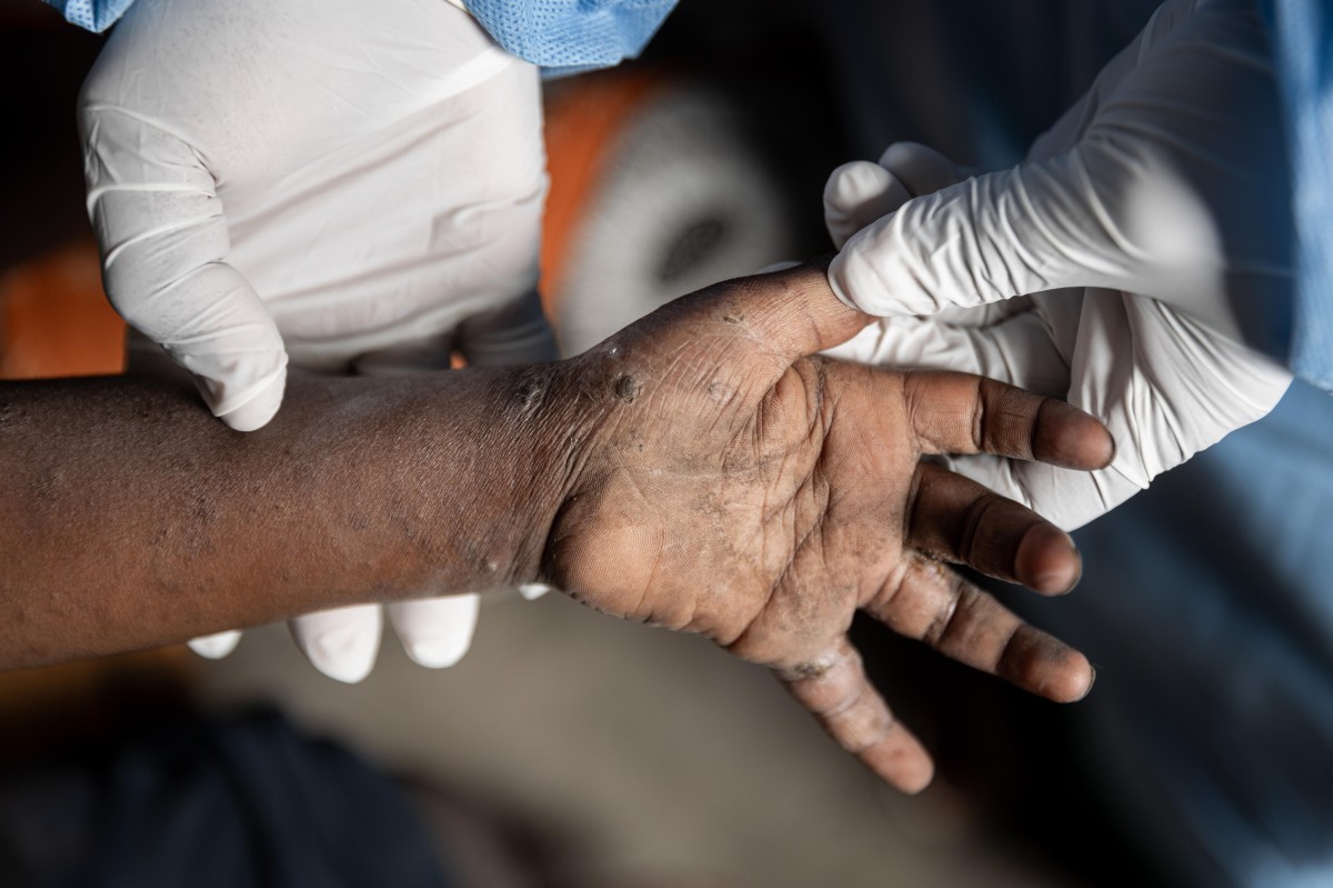 Mpox in the DRC: Working at the outbreak epicentre