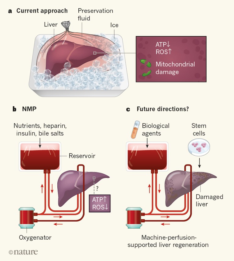 Life of a liver awaiting transplantation