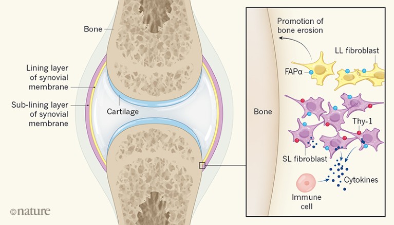 Two types of fibroblast drive arthritis