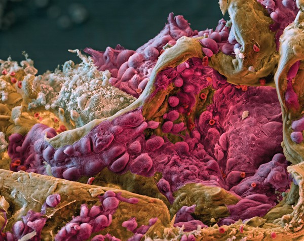 Research round-up: lung cancer