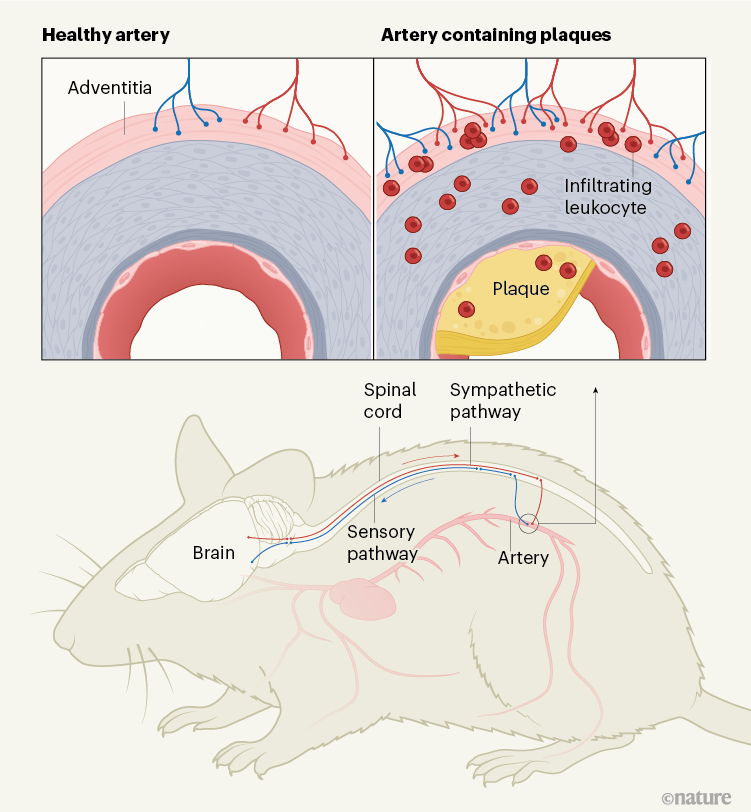 Crosstalk between nerves, immune cells and plaques drives atherosclerosis