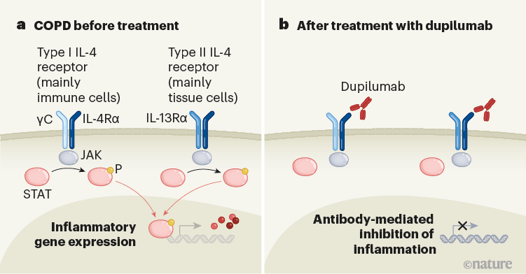 Immune treatment tackles chronic obstructive pulmonary disease