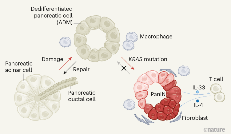 Calligraphy tool offers clues to the origin of pancreatic cancer