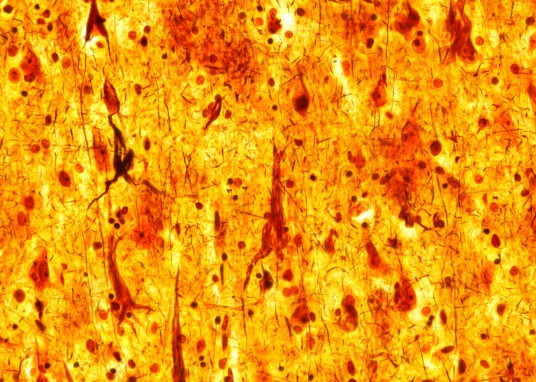 1985: Disentangling tau pathology