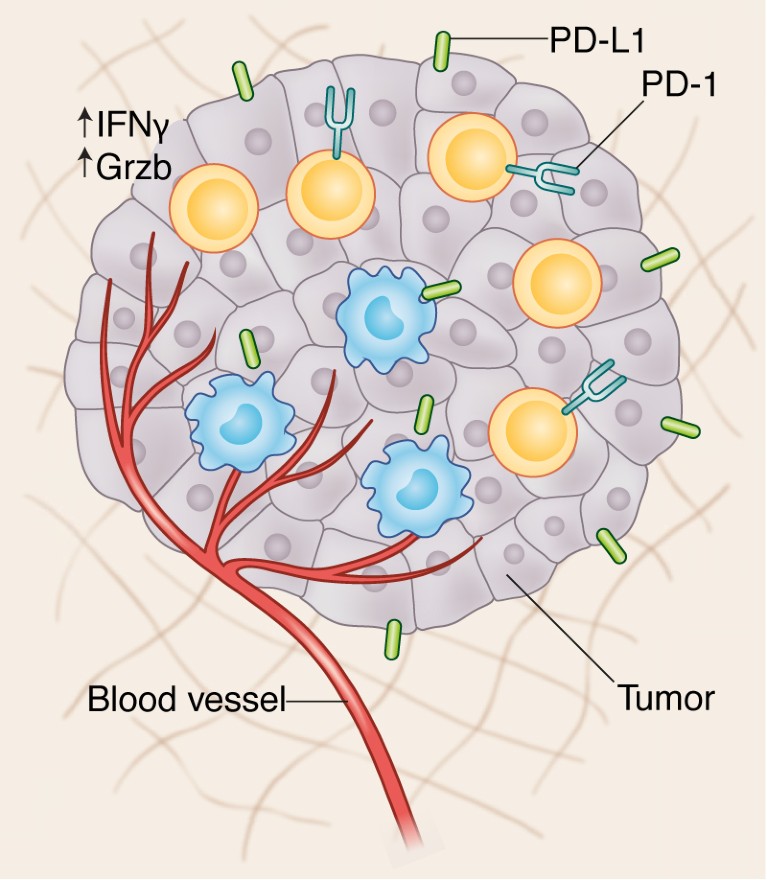 Pursuit of tumor-infiltrating lymphocyte immunotherapy speeds up