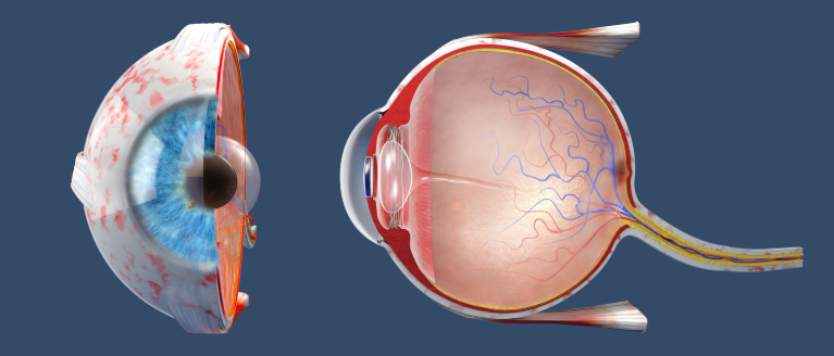 Improving implantable lenses to treat myopia