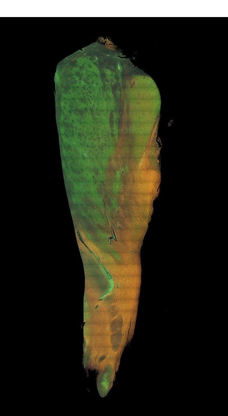 Searching for the biology behind bipolar disorders