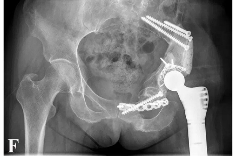 Rebuilding the pelvis after cancer surgery