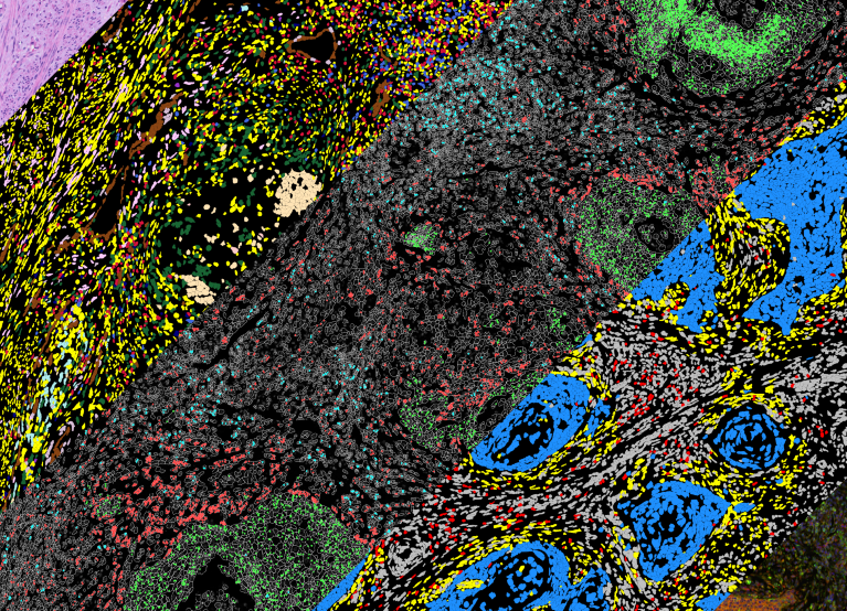 Mapping cellular neighbourhoods sheds light on cancer progression