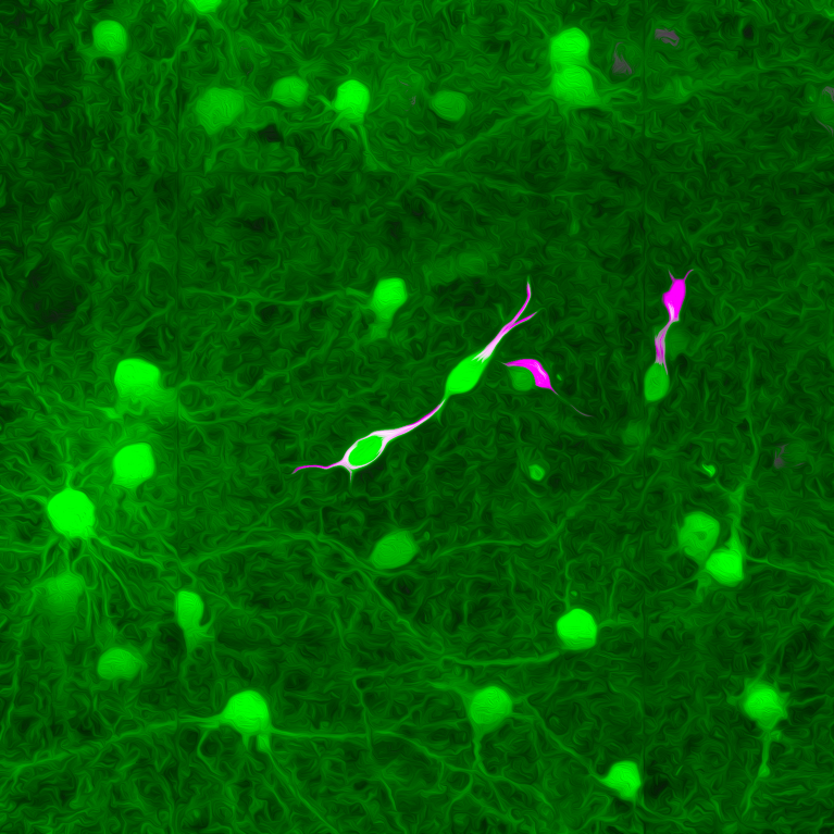 Cancer connections: how glioma cells form networks in the brain