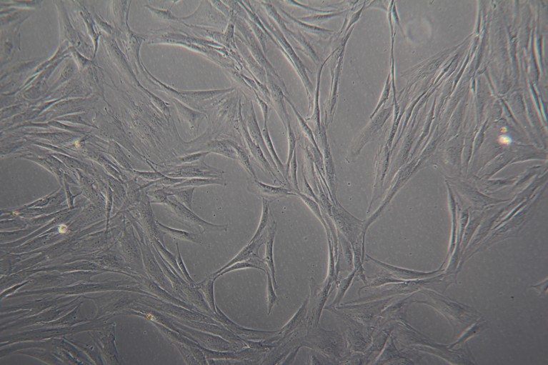 Post-traumatic stress damages skin cells involved in healing