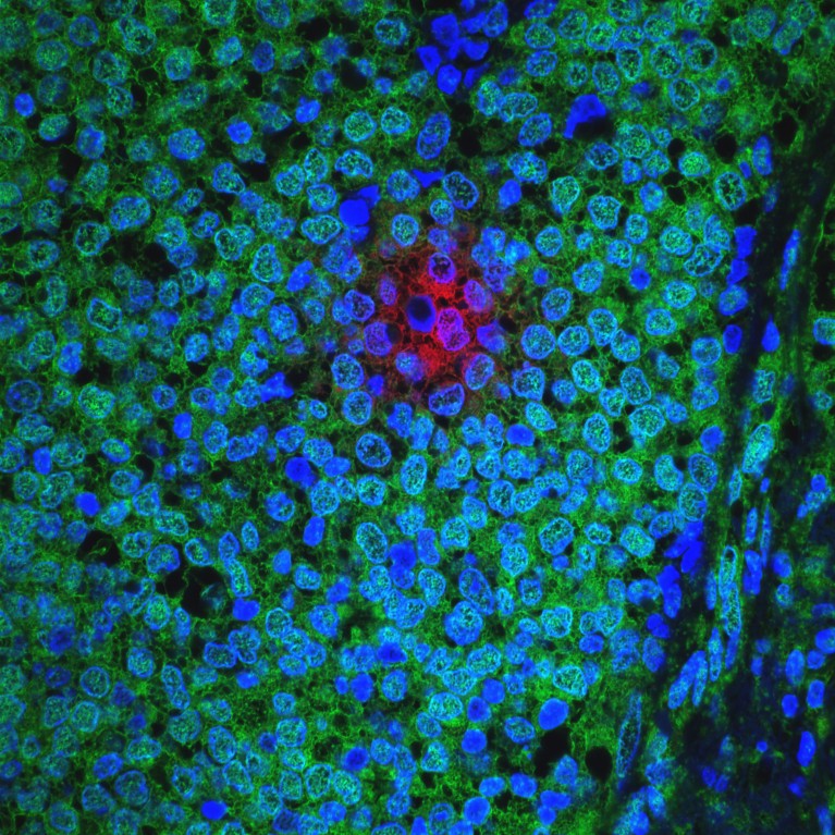 AI making cancer detection faster, more accurate