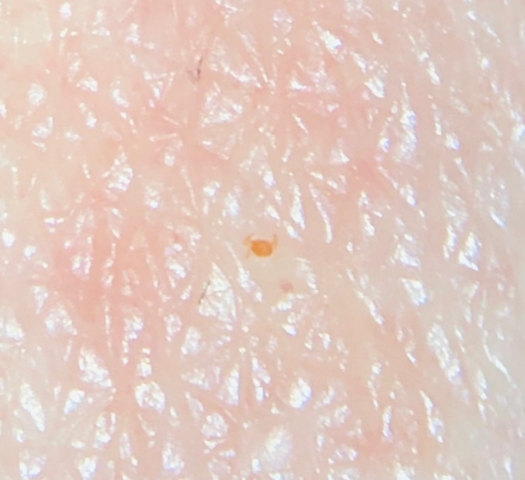 Model reveals trends in TB and scrub typhus co-infection