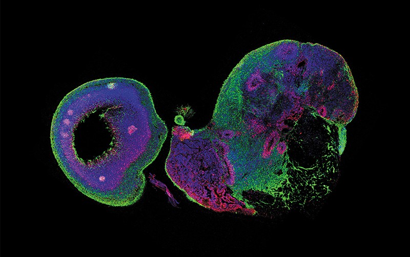 How cerebral organoids are guiding brain-cancer research and therapies