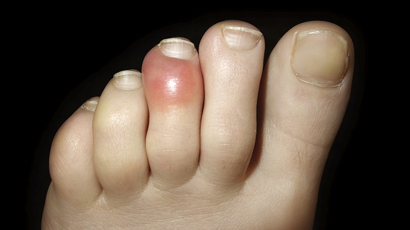 Are ‘COVID toes’ actually caused by the coronavirus?