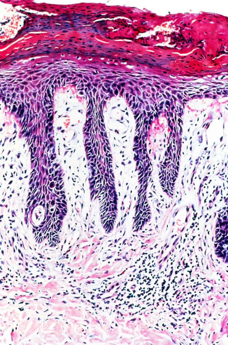 Psoriasis illuminates a path for immunologic advances