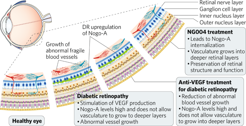 A new treatment for diabetic retinopathy