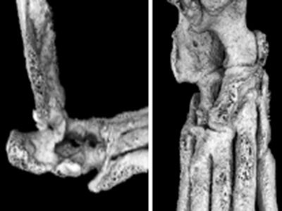 Two types of fibroblast drive arthritis