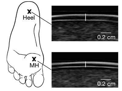 Walking on your sensitive sole
