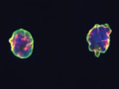 Base editor treats progeria in mice
