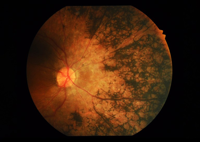 Cause of vision loss discovered in overlooked genes
